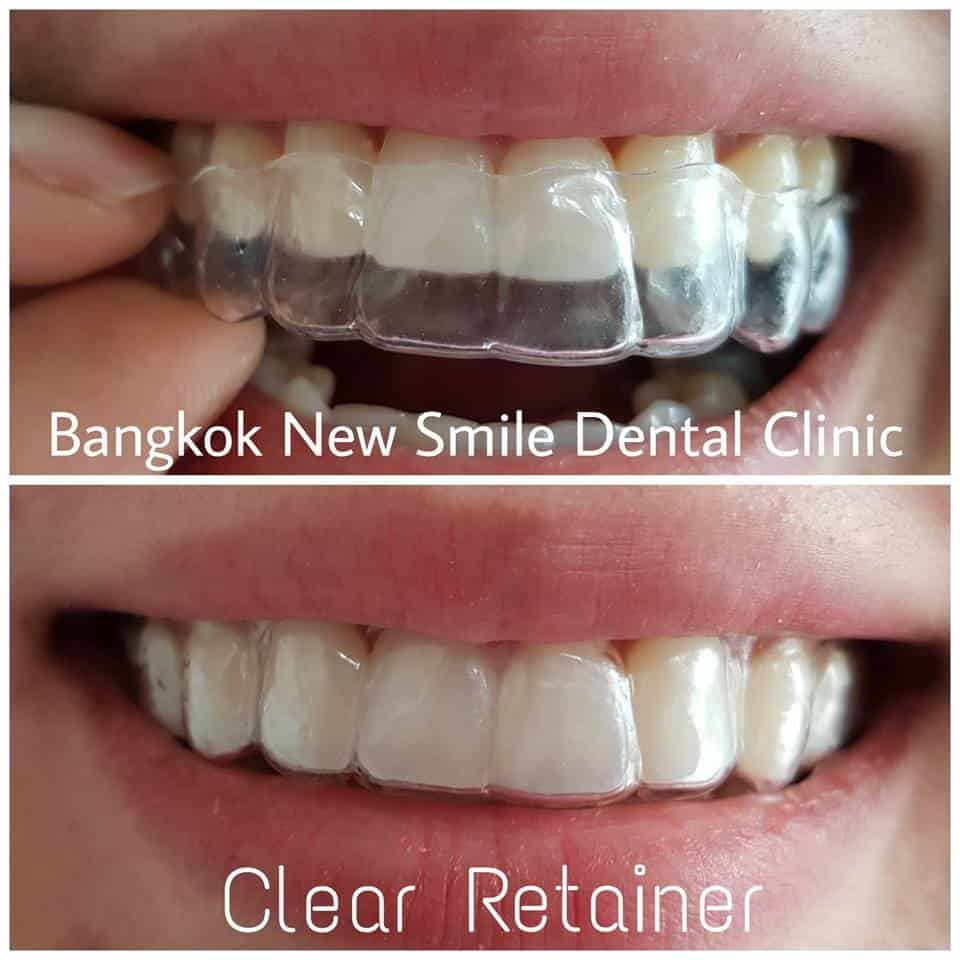 Retainer - คลินิกทันตกรรม Bangkok New Smile