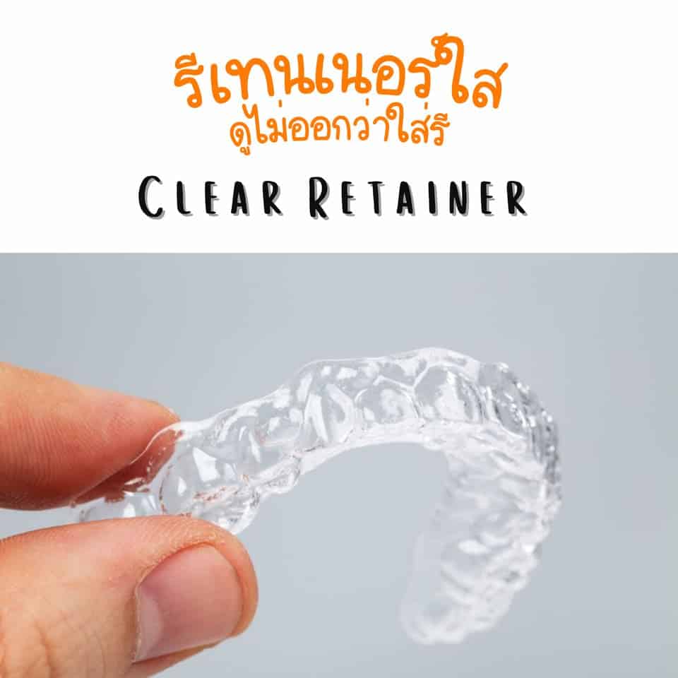 Retainer - คลินิกทันตกรรม Bangkok New Smile