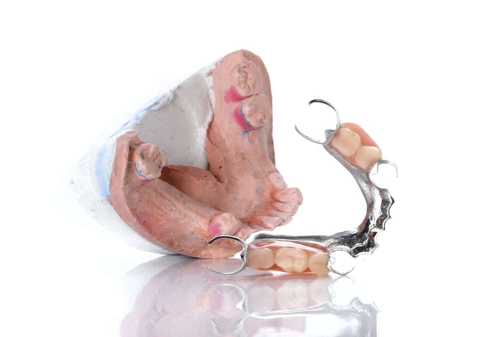 Removable Partial Denture – bangkoknewsmile