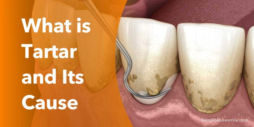 Scaling and Polishing - คลินิกทันตกรรม Bangkok New Smile